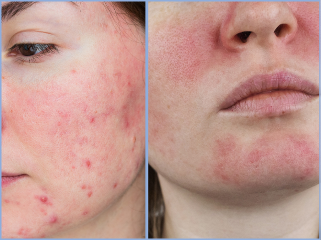 GP Workshop 'Acne, Rosacea & Maskne - Clinical Pearls: - Australian ...